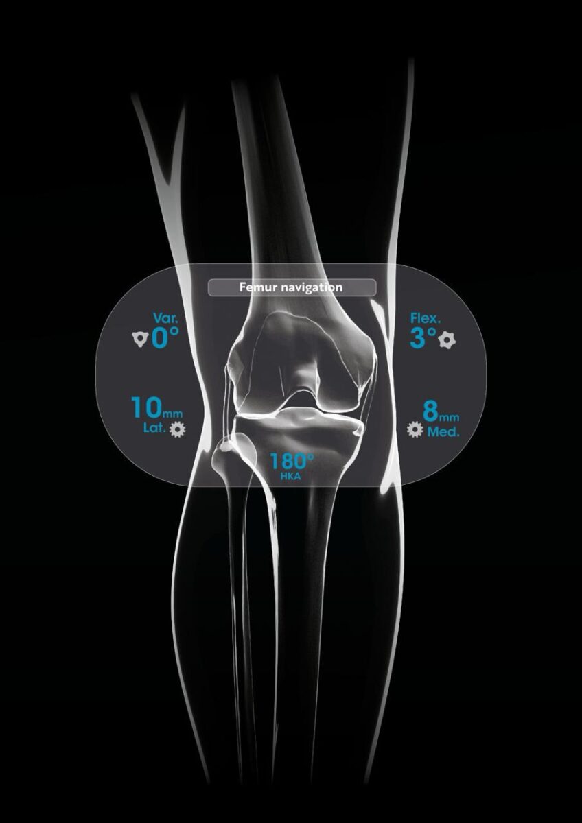 Pixee - A new vision for orthopedic surgery